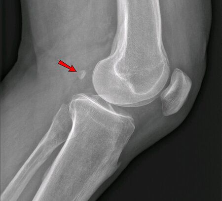 Fabella Syndrome - WikiSM (Sports Medicine Wiki)