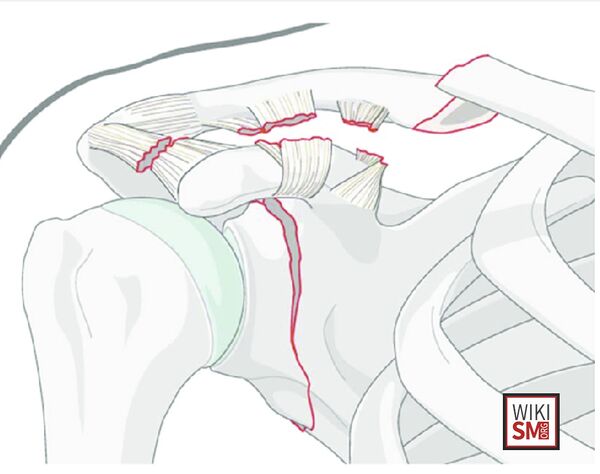 Floating Shoulder Injury - WikiSM (Sports Medicine Wiki)