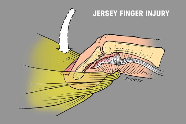 Finger Anatomy - WikiSM (Sports Medicine Wiki)