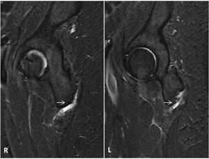 Ischial Bursitis - WikiSM (Sports Medicine Wiki)