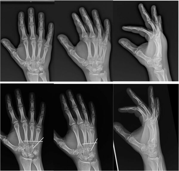 Carpometacarpal Joint Dislocation - WikiSM (Sports Medicine Wiki)