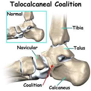 Tarsal Coalition - WikiSM (Sports Medicine Wiki)