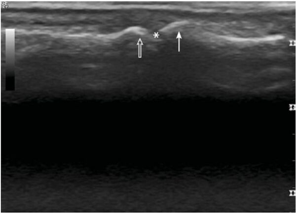 Interphalangeal Joint of the Foot Injection - WikiSM (Sports Medicine Wiki)