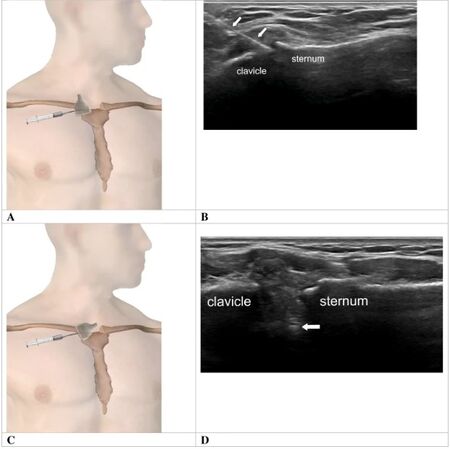 Sternoclavicular Joint Injection - WikiSM (Sports Medicine Wiki)