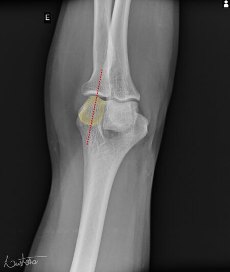 Radiocapitellar Line - WikiSM (Sports Medicine Wiki)
