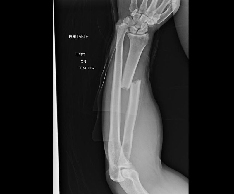 Galeazzi Fracture - WikiSM (Sports Medicine Wiki)