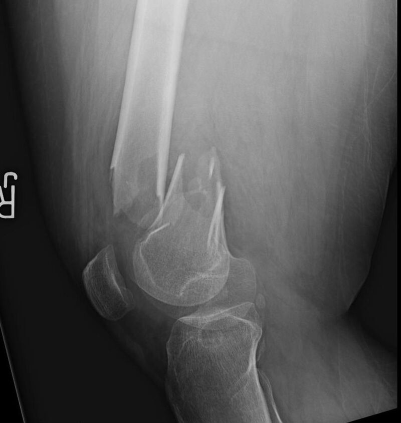 Medial Condyle Of Femur Fracture