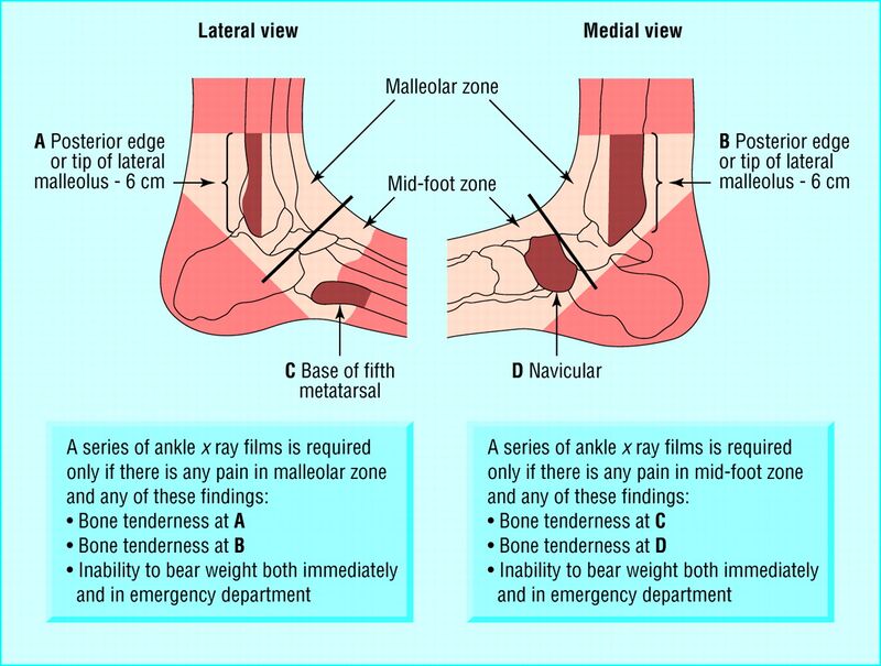 Ottawa Ankle Rules - WikiSM (Sports Medicine Wiki)