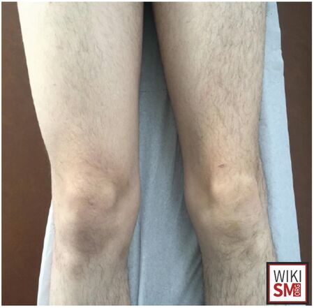 Femoral Neuropathy - WikiSM (Sports Medicine Wiki)