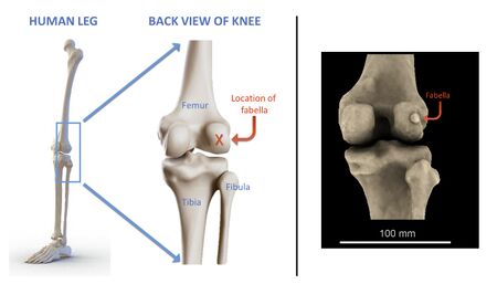 Fabella Syndrome - WikiSM (Sports Medicine Wiki)