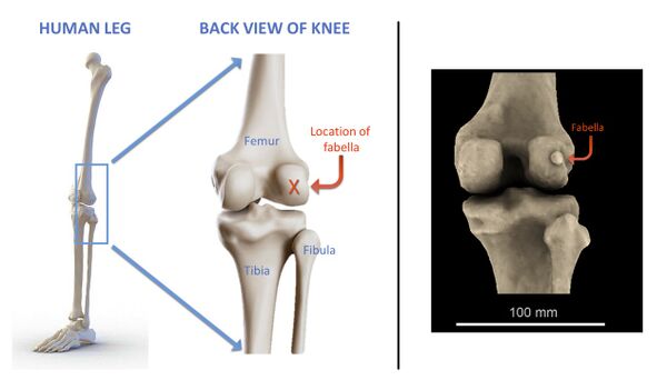 Fabella Syndrome - WikiSM (Sports Medicine Wiki)