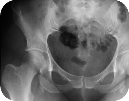 Ischial Bursitis - WikiSM (Sports Medicine Wiki)