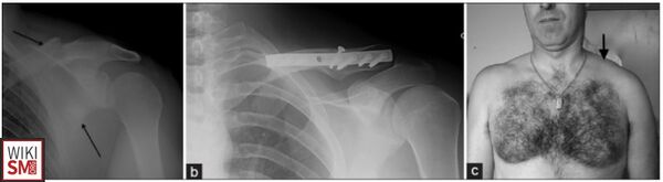 Floating Shoulder Injury - WikiSM (Sports Medicine Wiki)