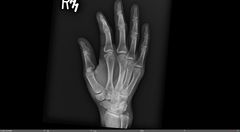 Standard Radiographs Hand - WikiSM