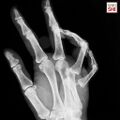 Deep Transverse Metacarpal Ligament - WikiSM (Sports Medicine Wiki)