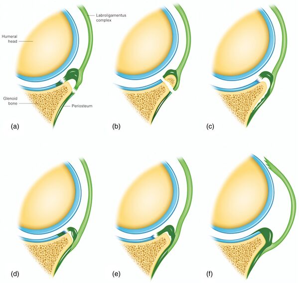 Bankart Lesion - WikiSM (Sports Medicine Wiki)