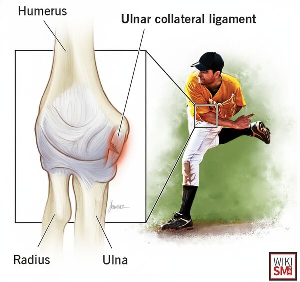 UCL Tear of the Elbow - WikiSM (Sports Medicine Wiki)