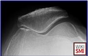 Patellofemoral Joint - WikiSM (Sports Medicine Wiki)