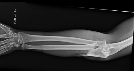 Monteggia Fracture - WikiSM (Sports Medicine Wiki)