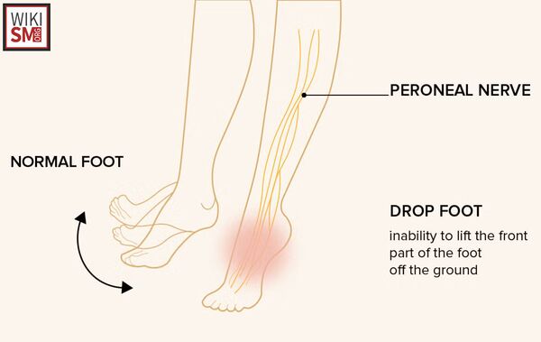 Foot Drop - WikiSM (Sports Medicine Wiki)