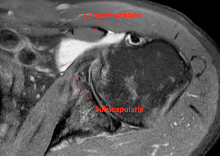 Subcoracoid Bursitis - WikiSM (Sports Medicine Wiki)
