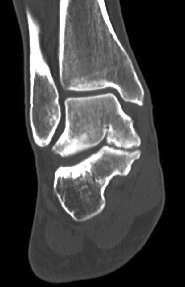 Tarsal Coalition - WikiSM (Sports Medicine Wiki)