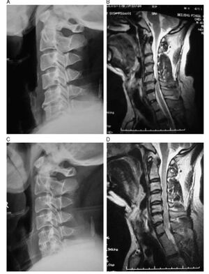Cervical Radiculopathy - WikiSM (Sports Medicine Wiki)