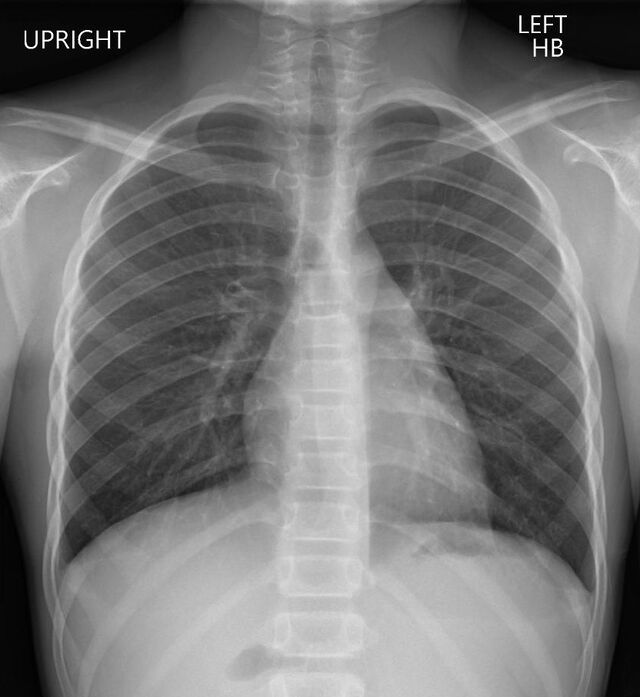 Standard Radiographs Chest - WikiSM