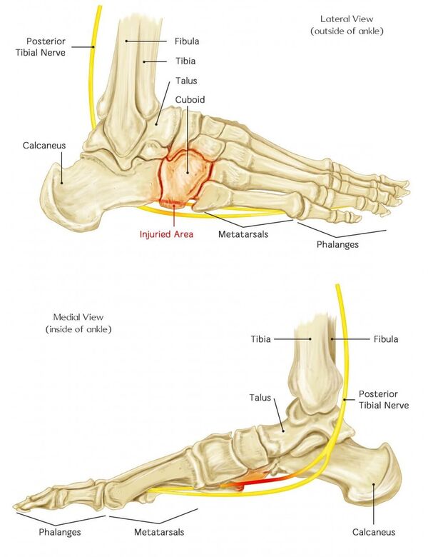 Cuboid Syndrome - WikiSM (Sports Medicine Wiki)