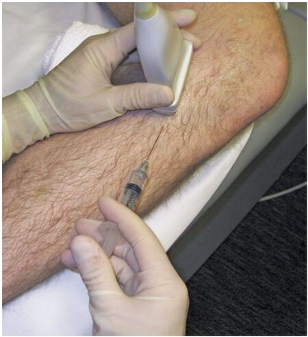 Pes Anserine Bursa Injection - WikiSM (Sports Medicine Wiki)