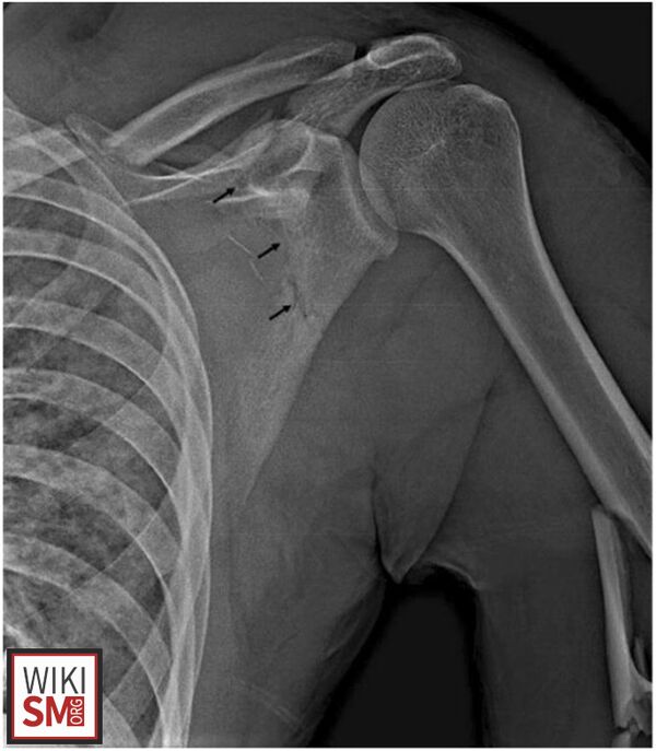 Floating Shoulder Injury - WikiSM (Sports Medicine Wiki)