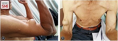 Popeye Deformity - WikiSM (Sports Medicine Wiki)