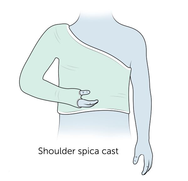 Shoulder Spica Cast - WikiSM (Sports Medicine Wiki)