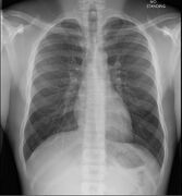 Standard Chest Radiograph - WikiSM