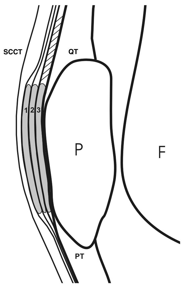 Prepatellar Bursa - WikiSM (Sports Medicine Wiki)