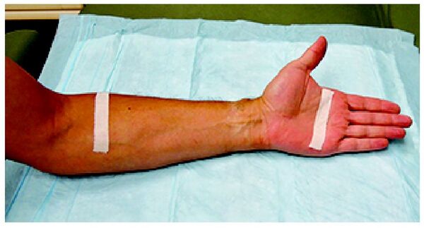 Forearm Volar Splint - WikiSM (Sports Medicine Wiki)
