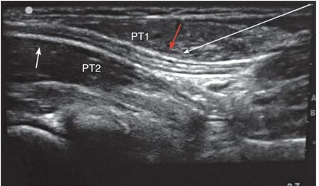 Median Nerve at the Pronator Teres Injection - WikiSM (Sports Medicine ...