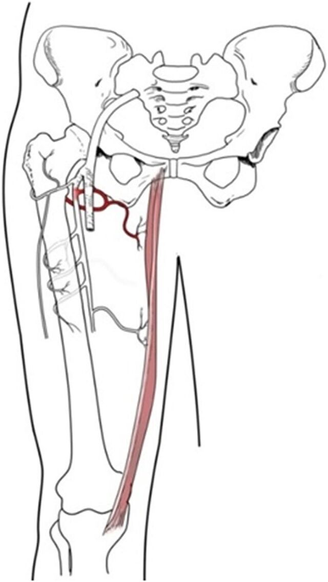 Gracilis - WikiSM (Sports Medicine Wiki)