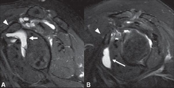 Subscapular Bursa - WikiSM (Sports Medicine Wiki)