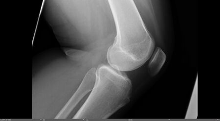 Knee Joint - WikiSM (Sports Medicine Wiki)