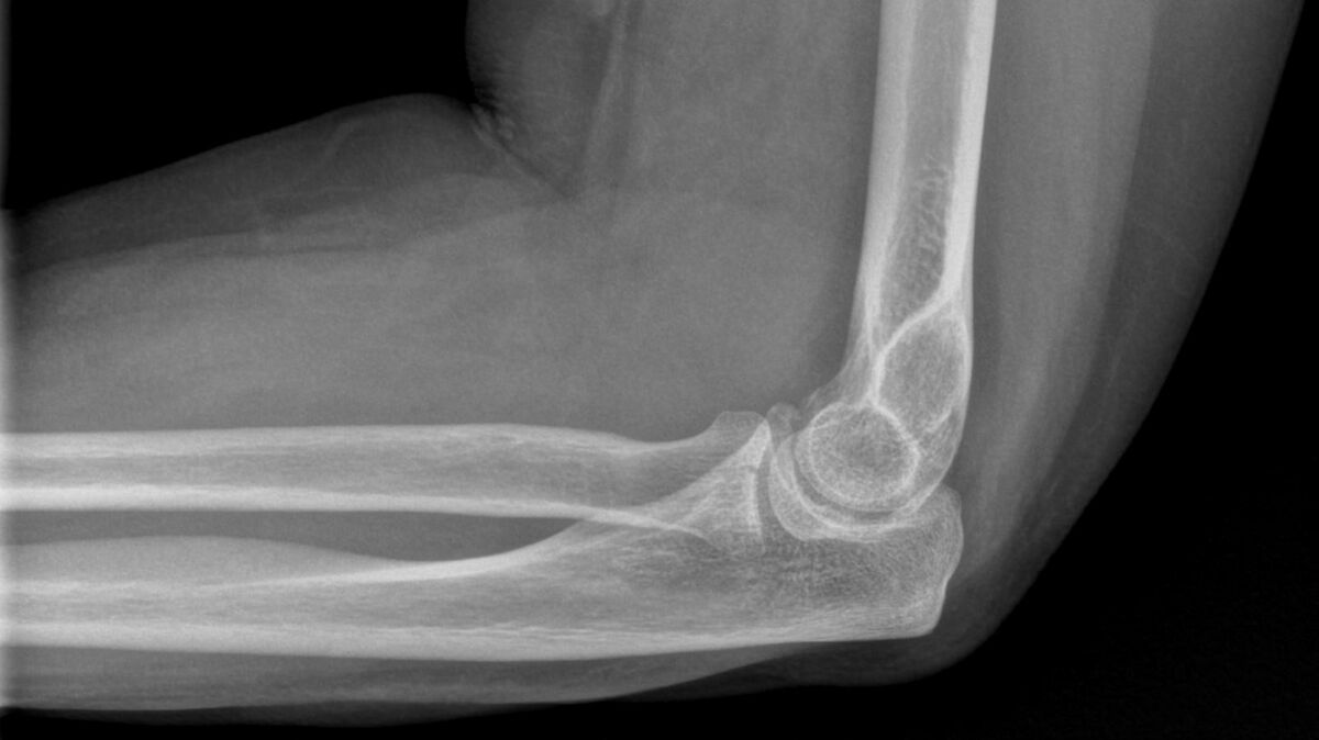 Proximal Radius Fracture - WikiSM (Sports Medicine Wiki)