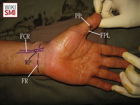 Flexor Pollicis Longus Rupture - WikiSM (Sports Medicine Wiki)