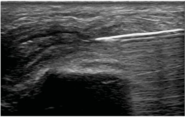 Prepatellar Bursal Injection - WikiSM (Sports Medicine Wiki)