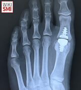 Metatarsophalangeal Joints - WikiSM (Sports Medicine Wiki)