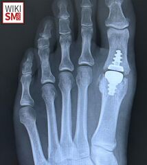 Metatarsophalangeal Joints - WikiSM (Sports Medicine Wiki)