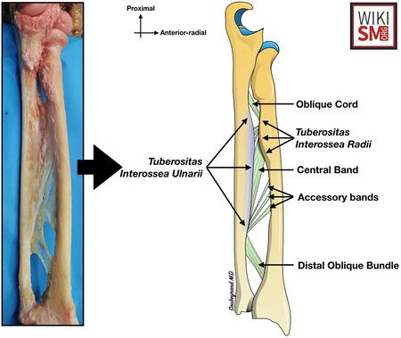 Interosseous Membrane of the Leg - WikiSM (Sports Medicine Wiki)