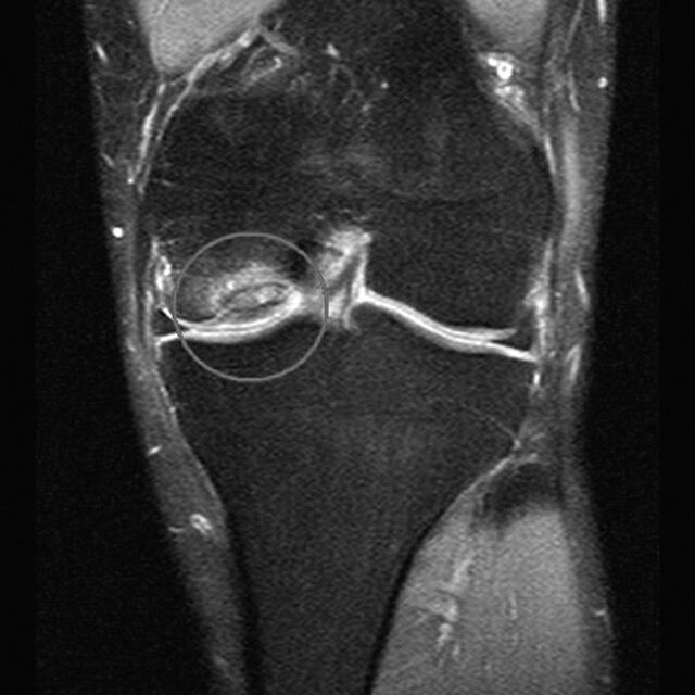 Osteochondral Defect Knee - WikiSM (Sports Medicine Wiki)