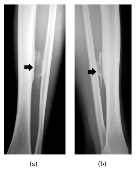 Interosseous Membrane of the Leg - WikiSM (Sports Medicine Wiki)