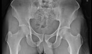 Standard Radiographs Hip - WikiSM (Sports Medicine Wiki)
