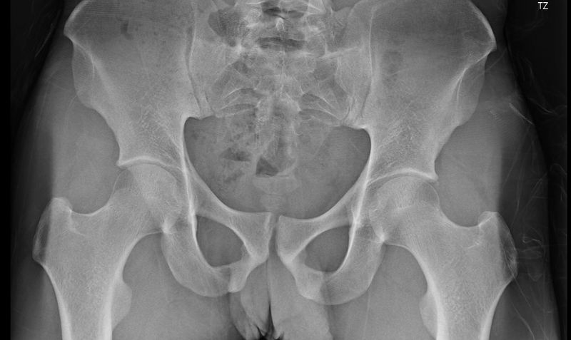 Standard Radiographs Hip - WikiSM (Sports Medicine Wiki)